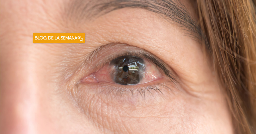 PTERIGIÓN ¿CÓMO PREVENIRLO? | Centro Médico Daniel Alcides Carrión